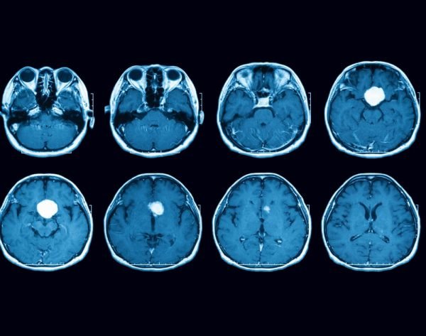 Pick’s Disease and Connection with Dementia - ReaDementia